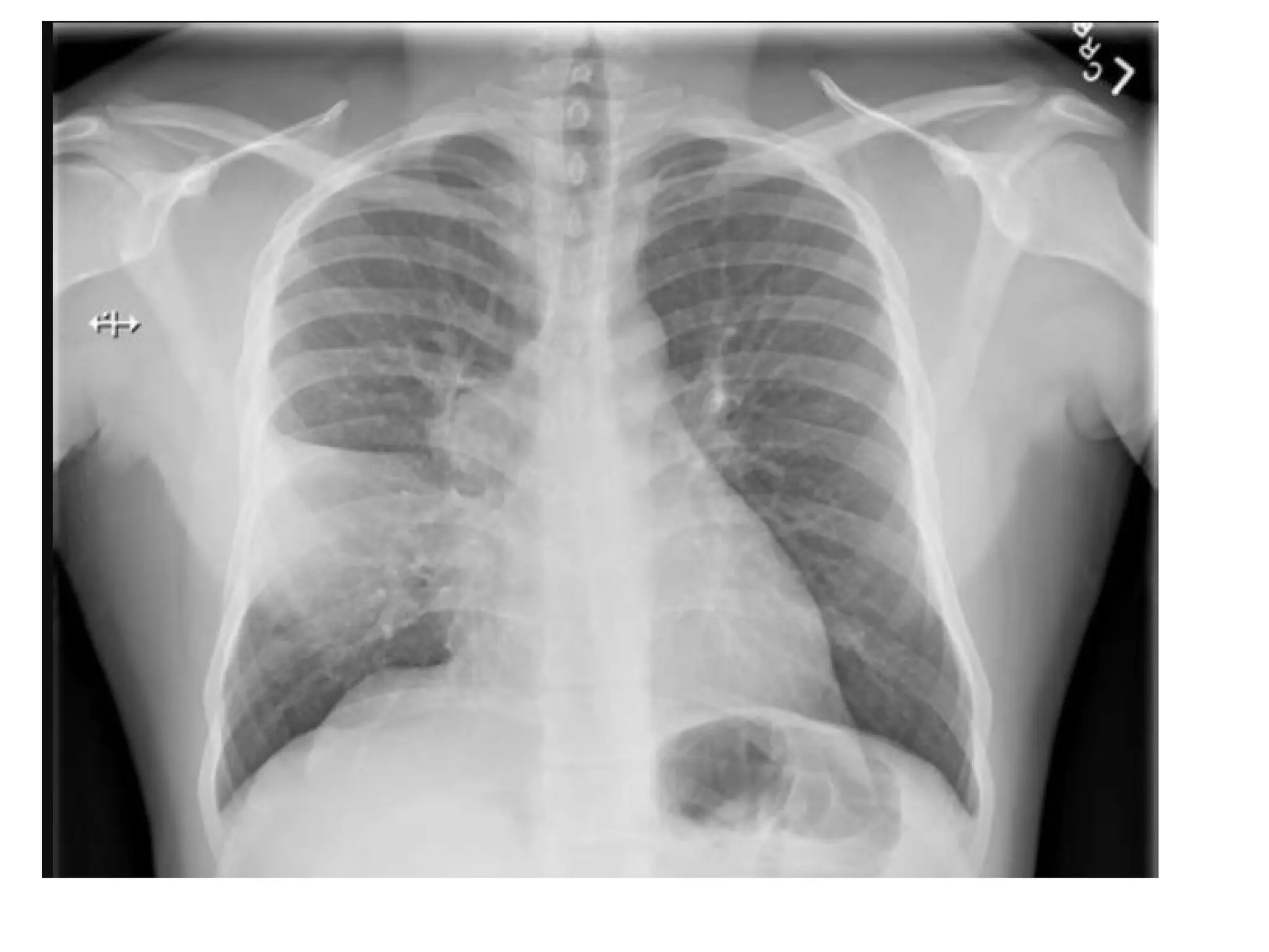 Chest X ray ap and pa view , findings in various diseases | PPT