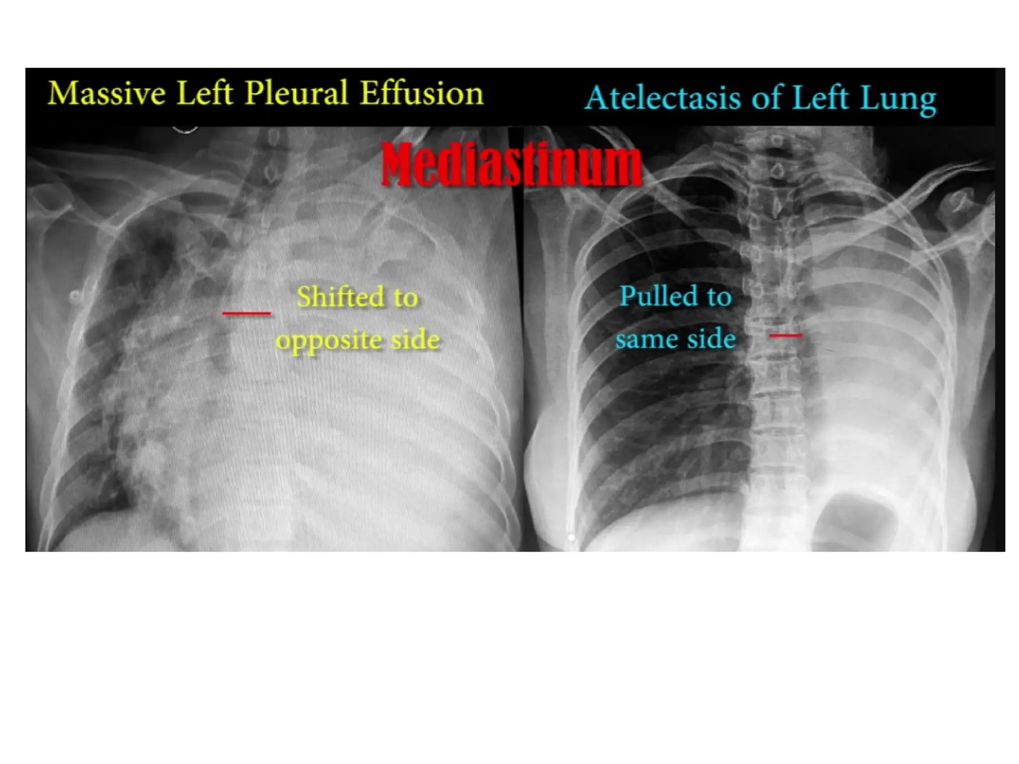 Chest X ray ap and pa view , findings in various diseases | PPTX