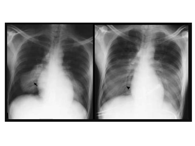 Chest X ray ap and pa view , findings in various diseases | PPT