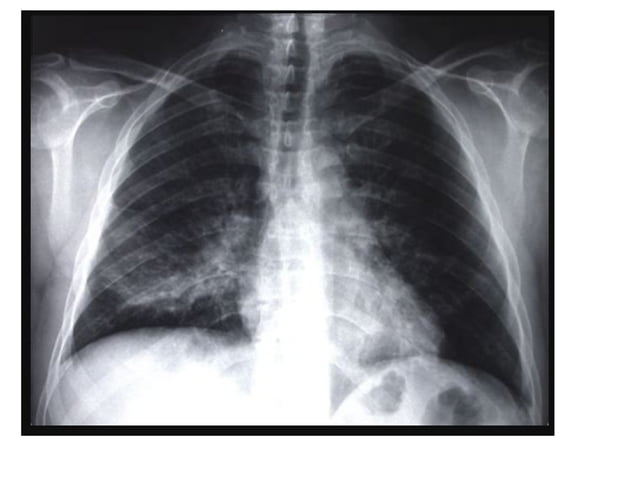 Chest X ray ap and pa view , findings in various diseases | PPT