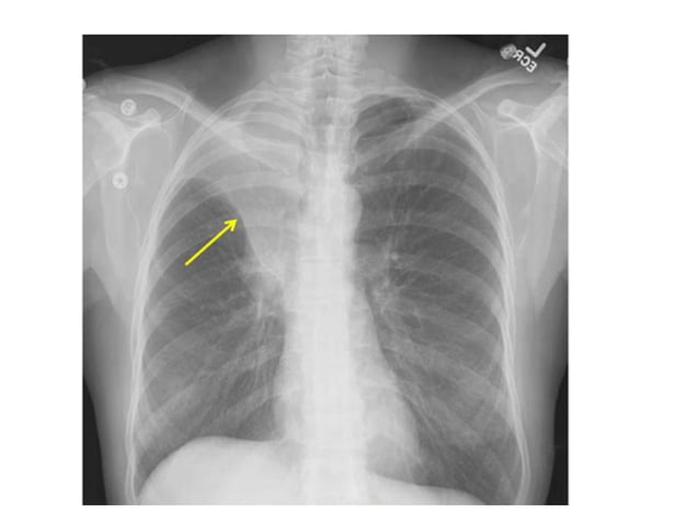 Chest X ray ap and pa view , findings in various diseases | PPT