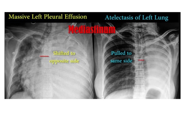 Chest X ray ap and pa view , findings in various diseases | PPT
