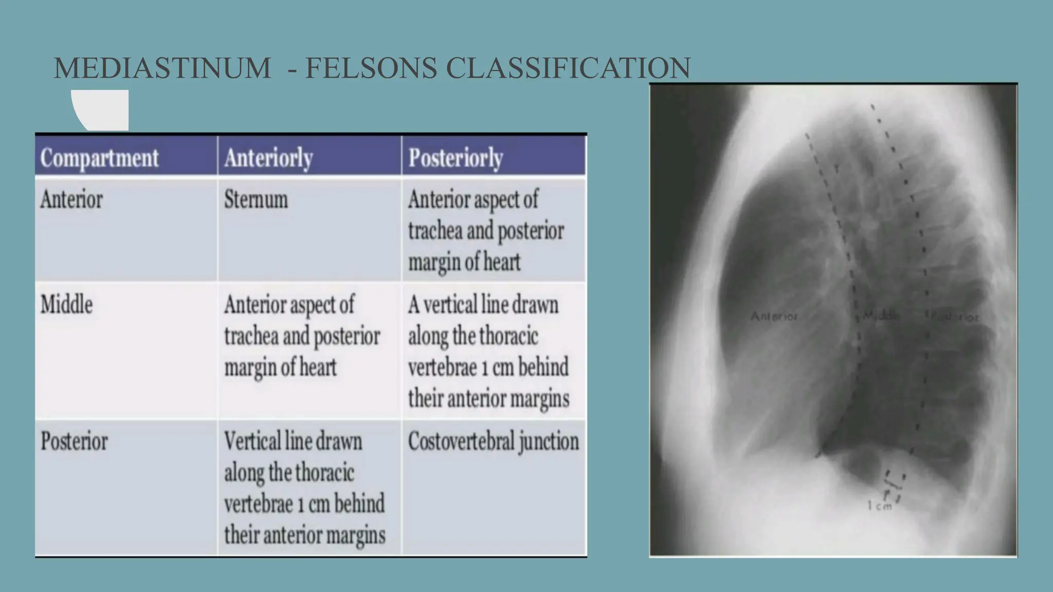 Chest xray -Lateral view radiology basics | PDF