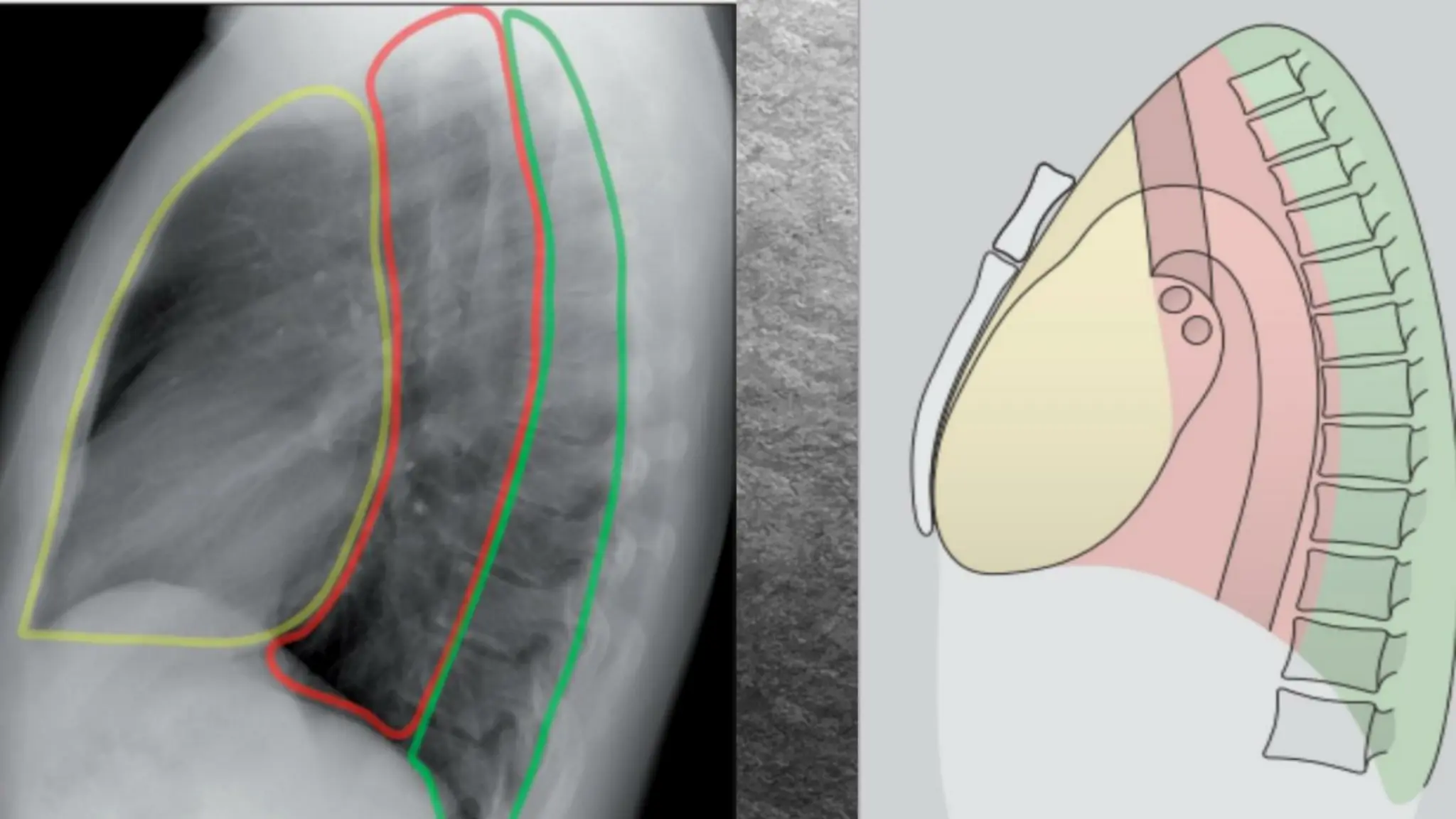 Chest xray -Lateral view radiology basics | PDF