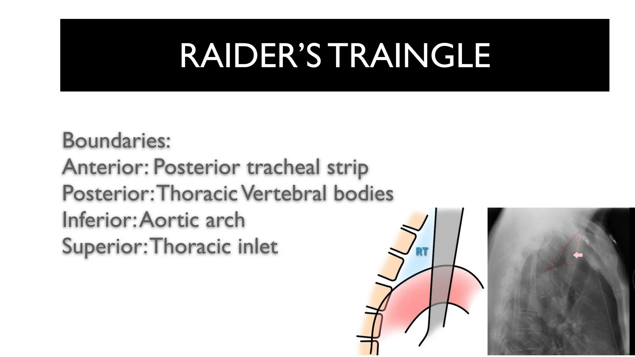 Chest xray -Lateral view radiology basics | PDF