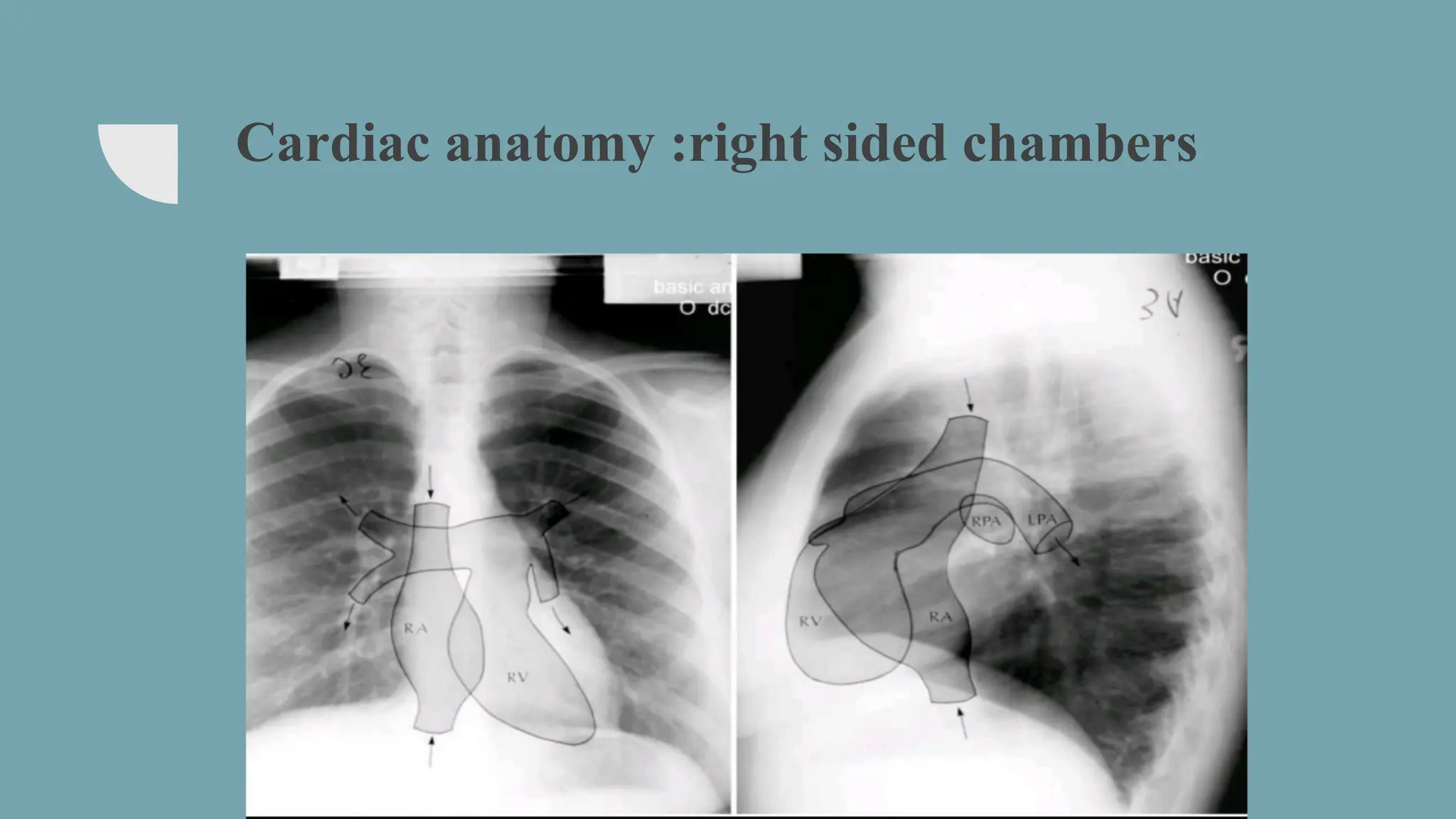 Chest xray -Lateral view radiology basics | PDF