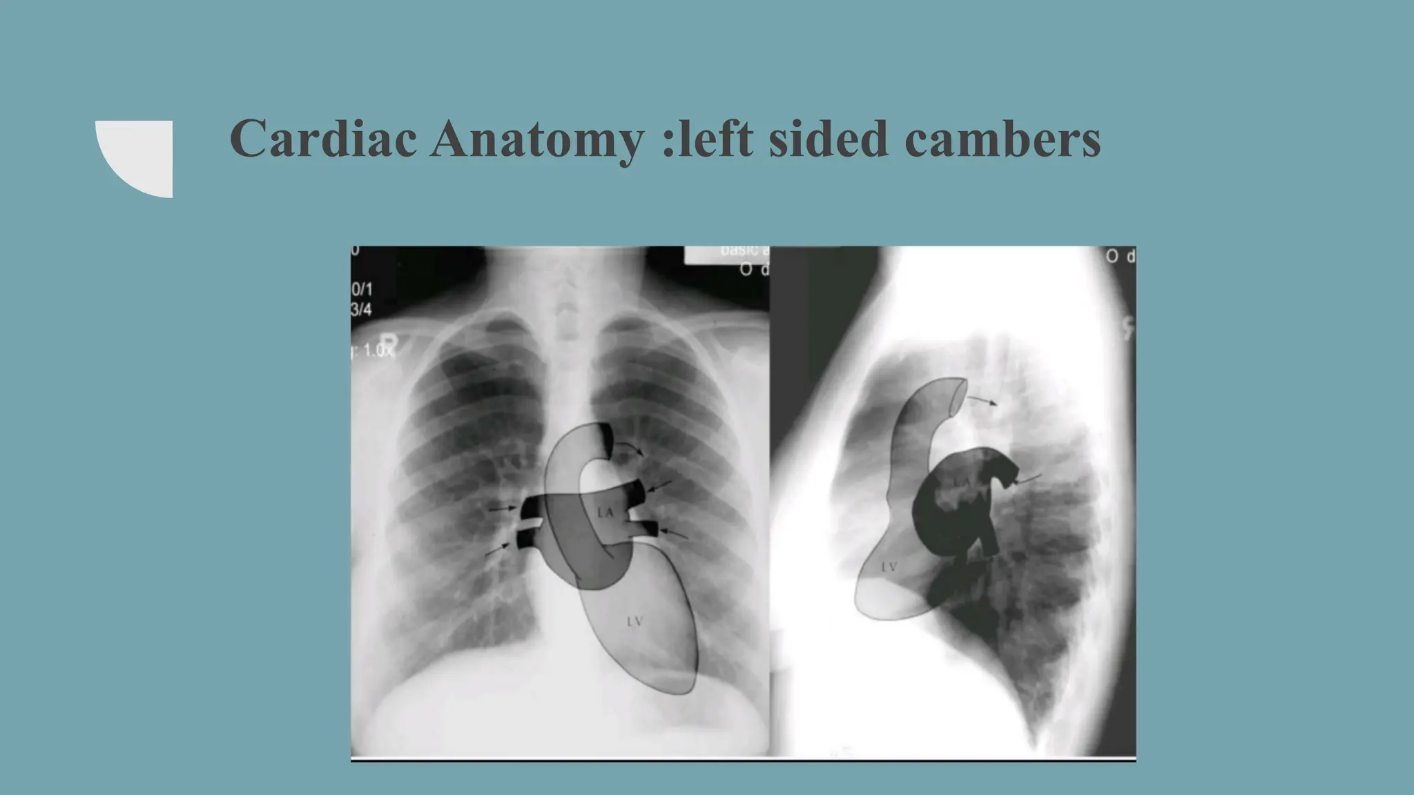 Chest xray -Lateral view radiology basics | PDF