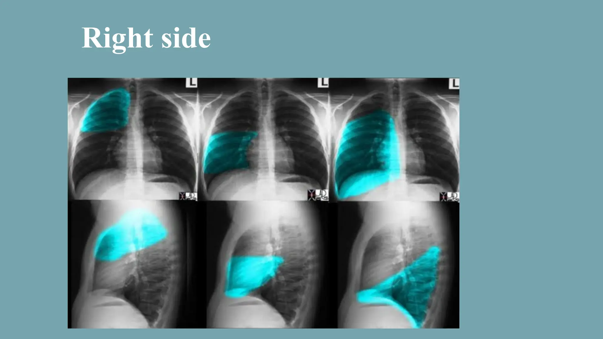 Chest xray -Lateral view radiology basics | PDF