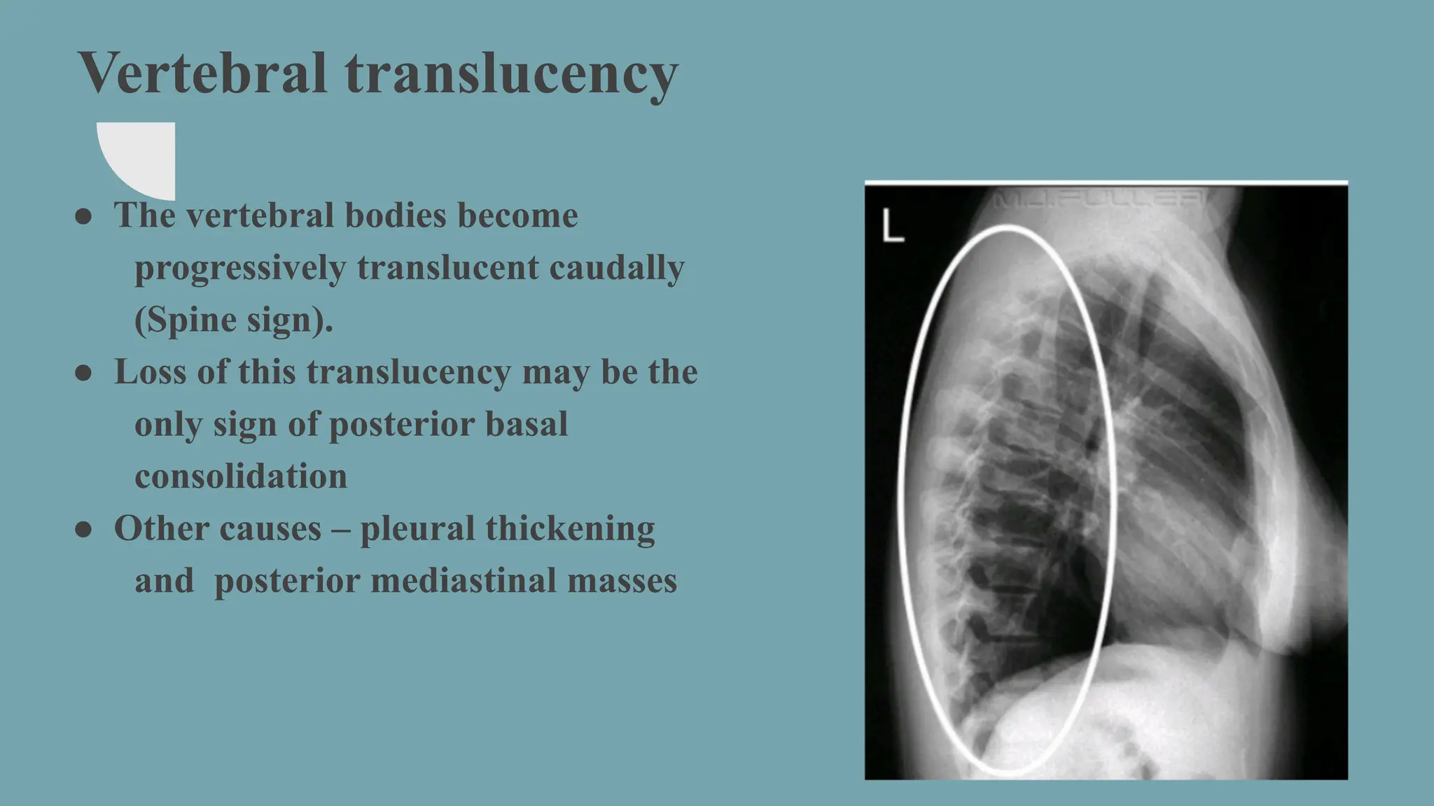 Chest xray -Lateral view radiology basics | PDF