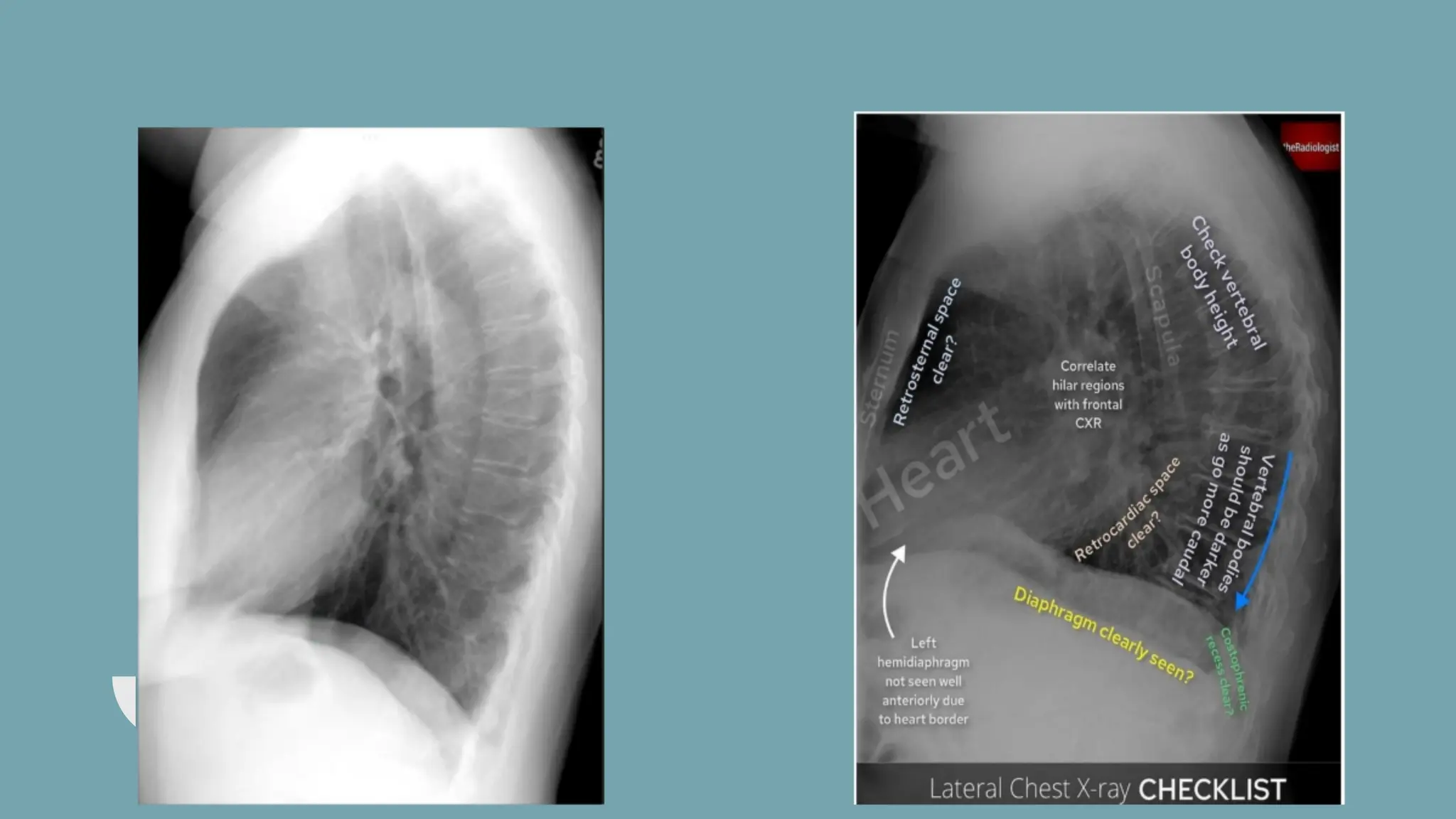 Chest xray -Lateral view radiology basics | PDF