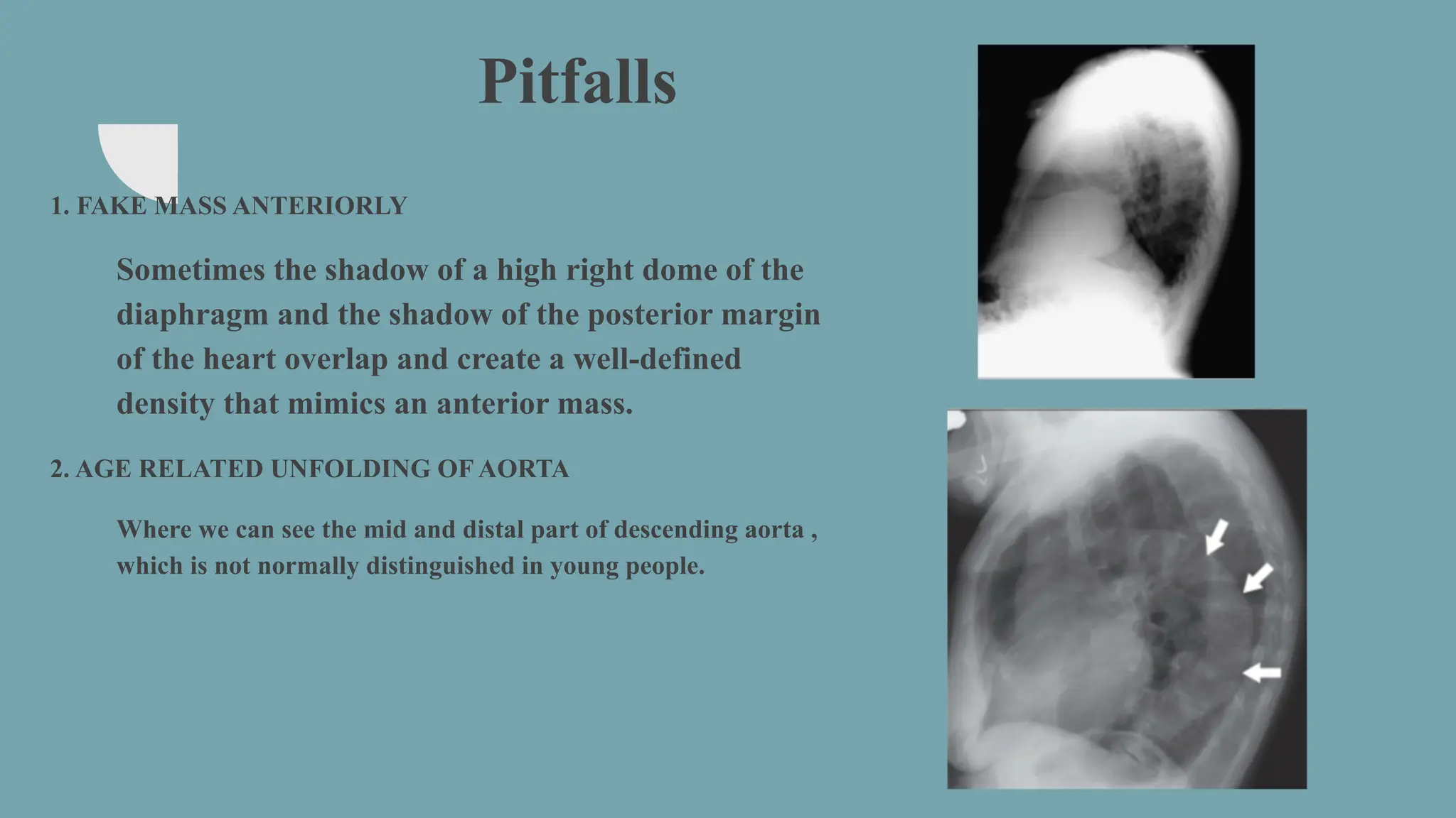 Chest xray -Lateral view radiology basics | PDF