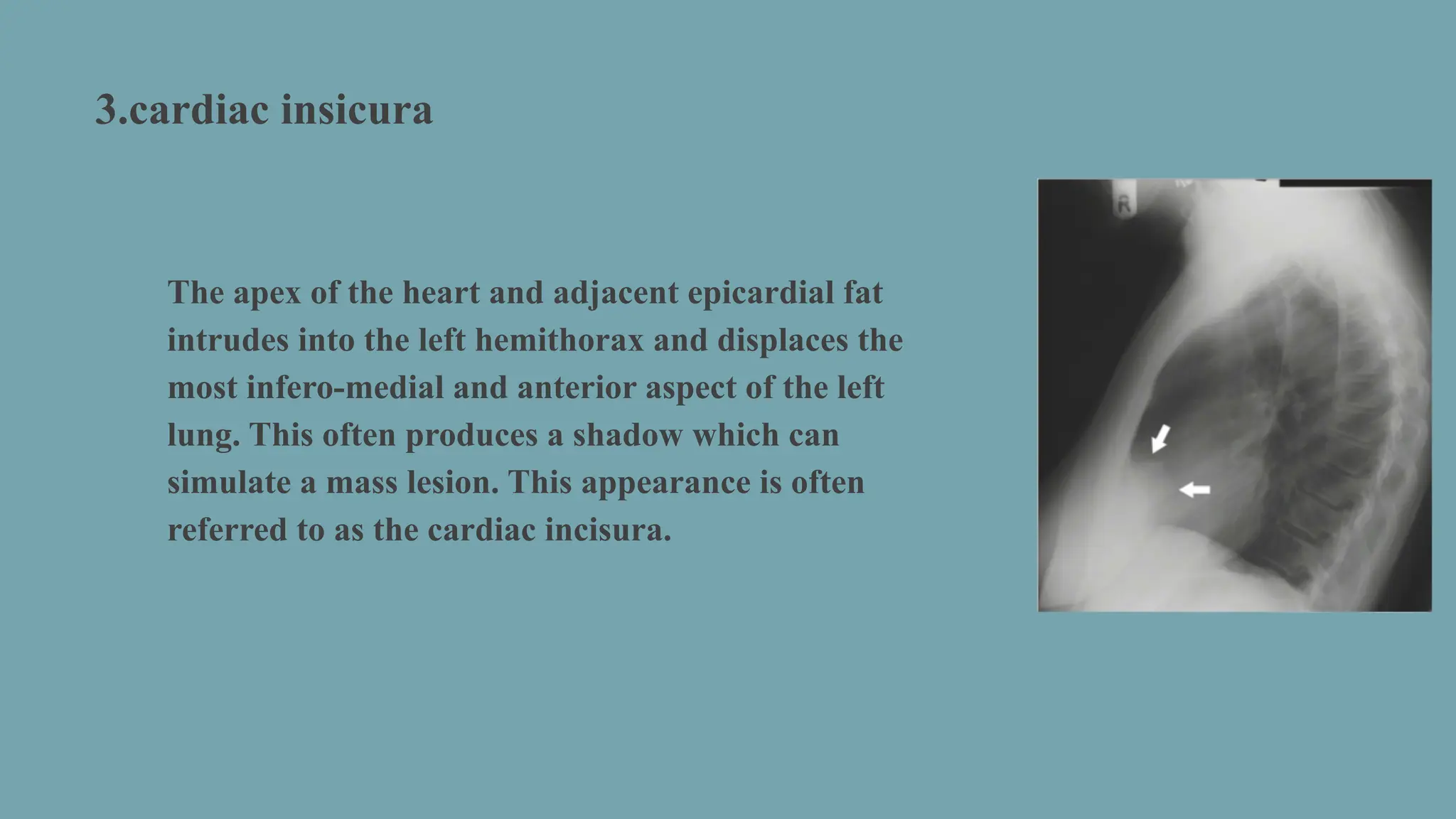 Chest xray -Lateral view radiology basics | PDF