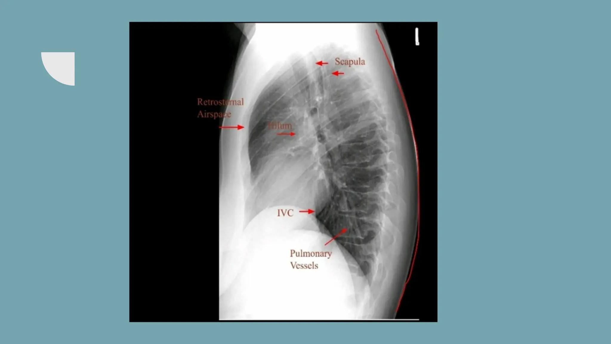 Chest xray -Lateral view radiology basics | PDF