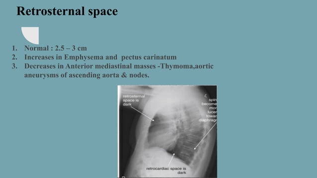 Chest xray -Lateral view radiology basics | PDF