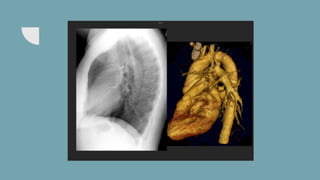 Chest xray -Lateral view radiology basics | PDF