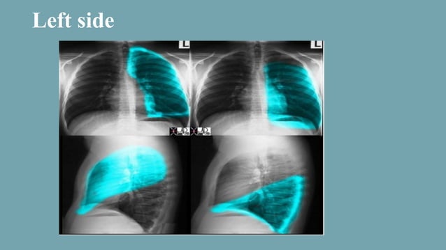 Chest xray -Lateral view radiology basics | PDF