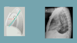 Chest xray -Lateral view radiology basics | PDF