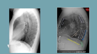 Chest xray -Lateral view radiology basics | PDF