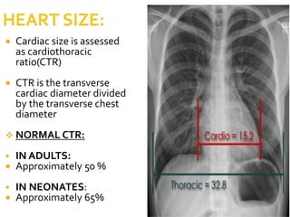 chest x ray 2.pptx
