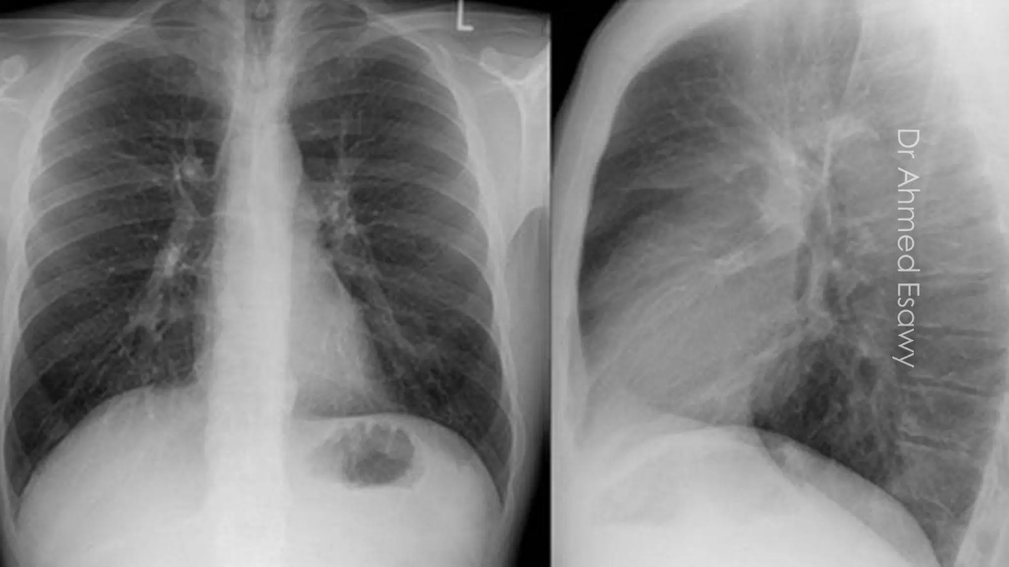Chest x ray anatomy basics | PPTX