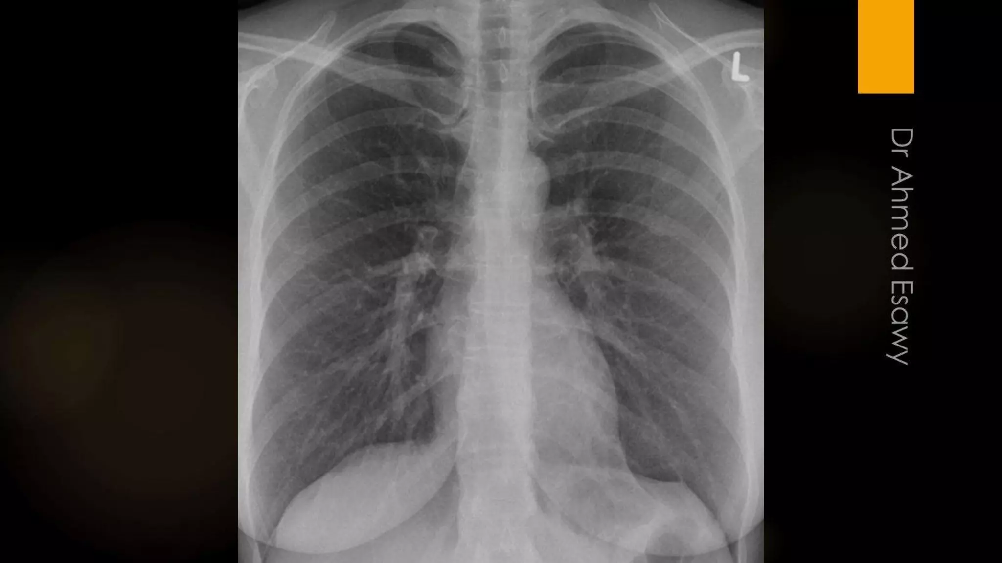 Chest x ray anatomy basics | PPTX