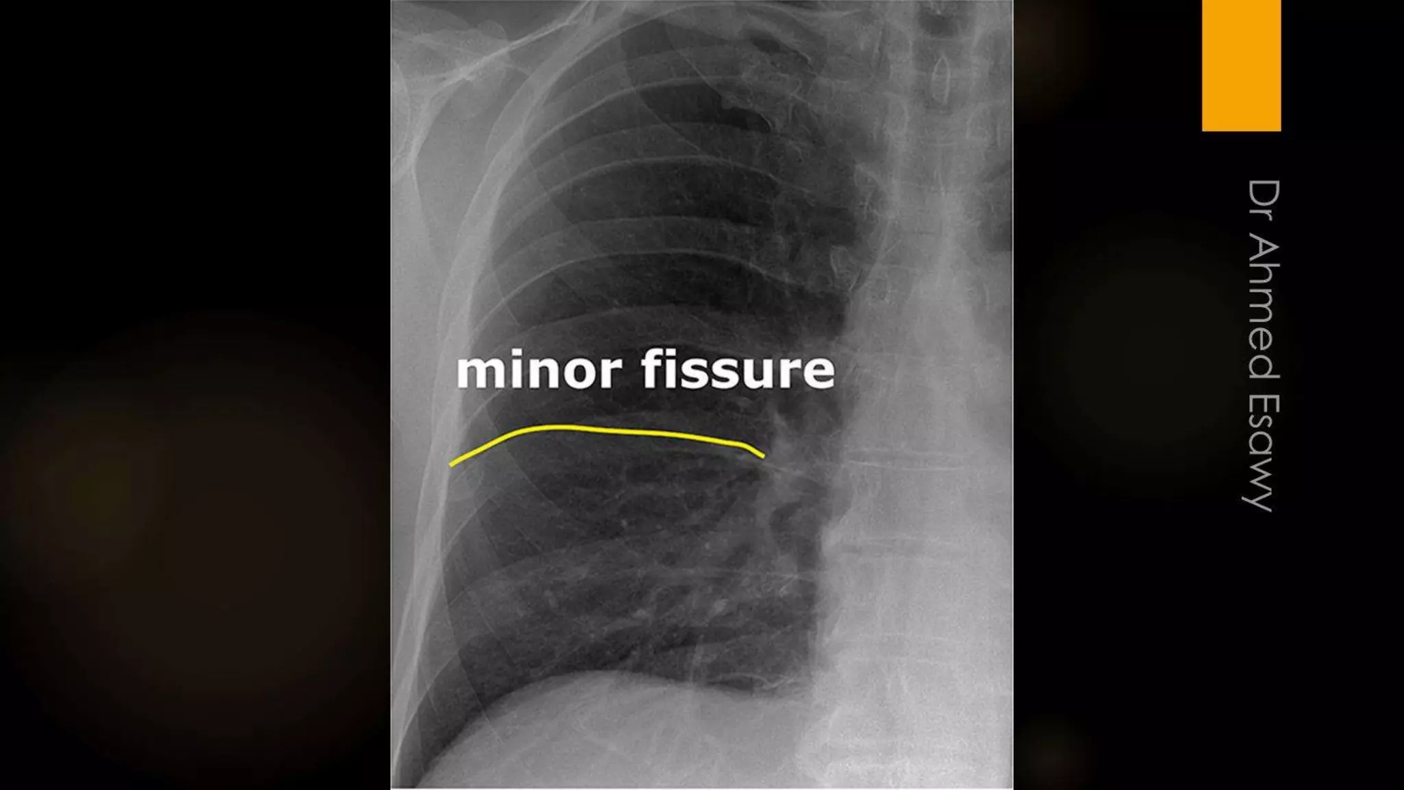 Chest x ray anatomy basics | PPTX