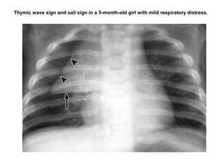 Chest XRay and other imaging investigations of chest, CT chest, HRCT ...