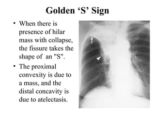 Chest XRay and other imaging investigations of chest, CT chest, HRCT ...