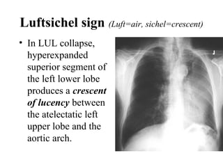 Chest XRay and other imaging investigations of chest, CT chest, HRCT ...