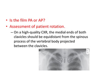 Chest x ray basic | PDF