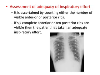 Chest x ray basic | PDF