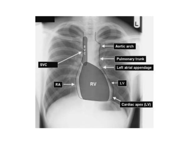 Chest x ray basic | PPT