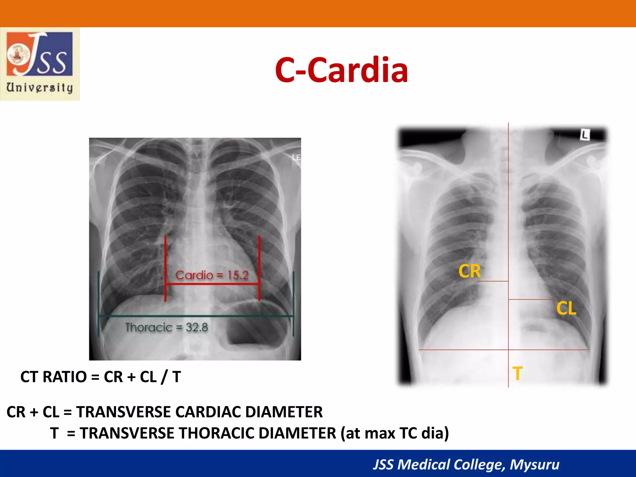 Chest x ray basic interpretation | PPTX