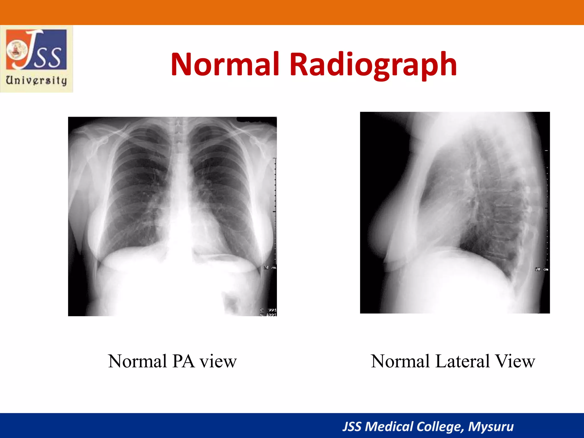 Chest x ray basic interpretation | PPTX