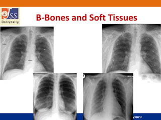 Chest x ray basic interpretation | PPTX