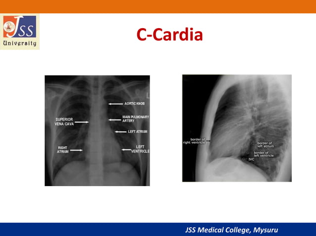 Chest x ray basic interpretation | PPTX