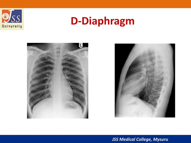 Chest x ray basic interpretation | PPTX