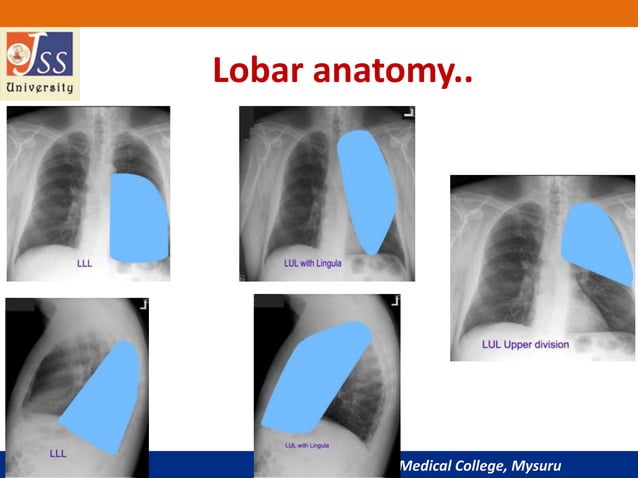 Chest x ray basic interpretation | PPTX