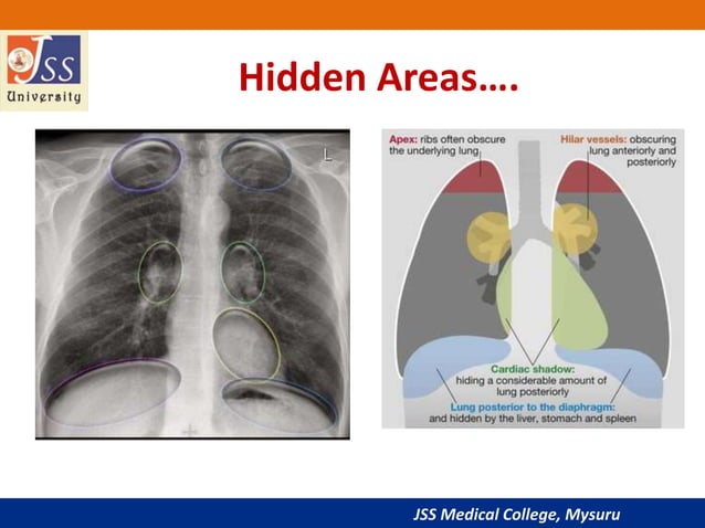 Chest x ray basic interpretation | PPTX