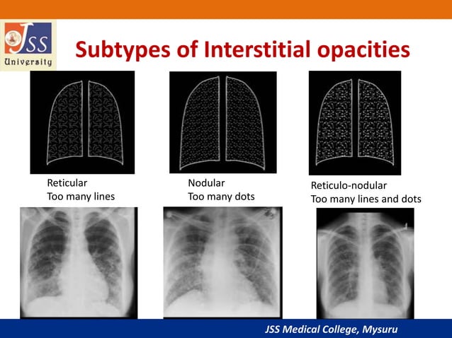 Chest x ray basic interpretation | PPTX