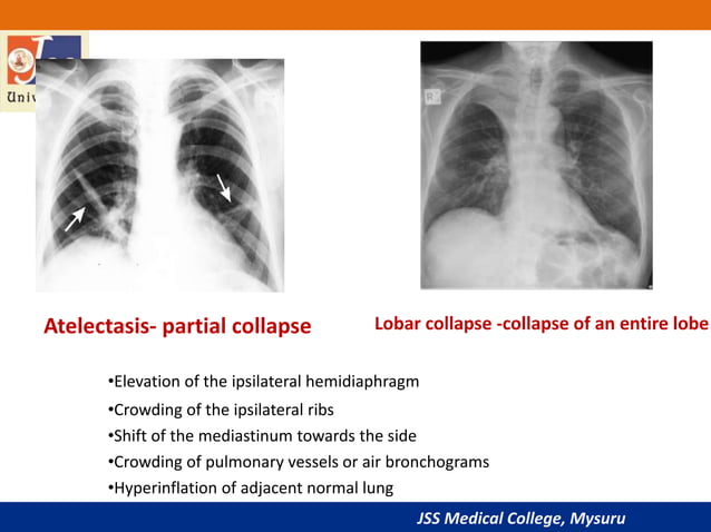 Chest x ray basic interpretation | PPTX