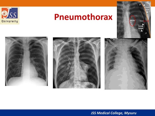 Chest x ray basic interpretation | PPTX