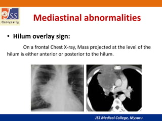 Chest x ray basic interpretation | PPTX
