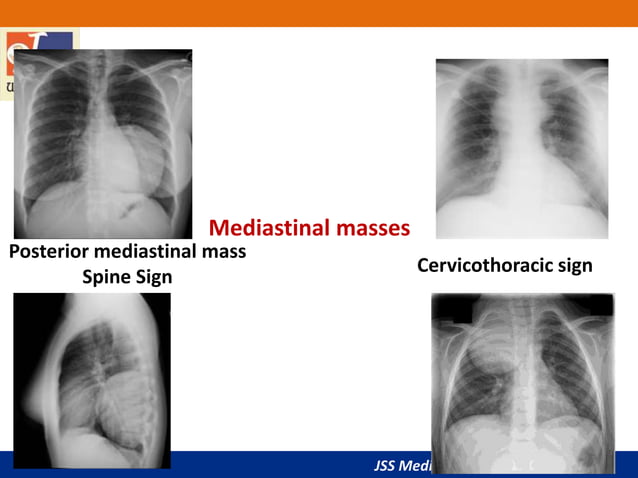 Chest x ray basic interpretation | PPTX