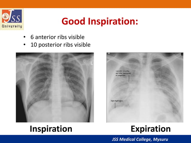 Chest x ray basic interpretation | PPTX
