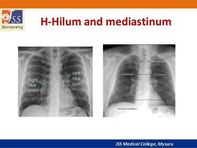 Chest x ray basic interpretation