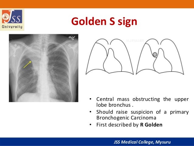 Chest x ray basic interpretation