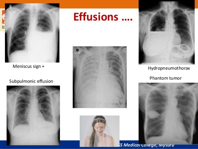 Chest x ray basic interpretation