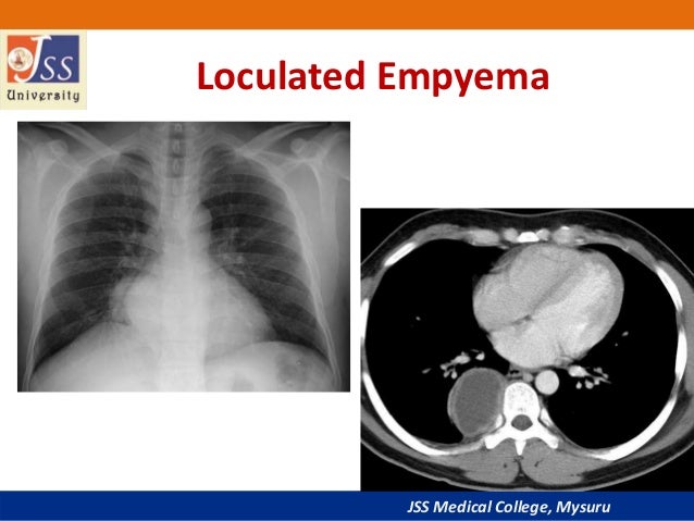 Chest x ray basic interpretation