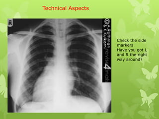 Chest x ray basics | PPTX